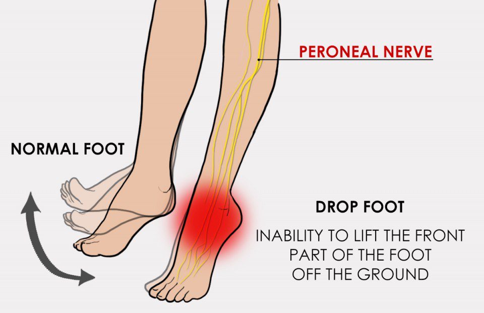 Foot Drop The Foot And Ankle Clinic Foot Drop The Foot And Ankle Clinic